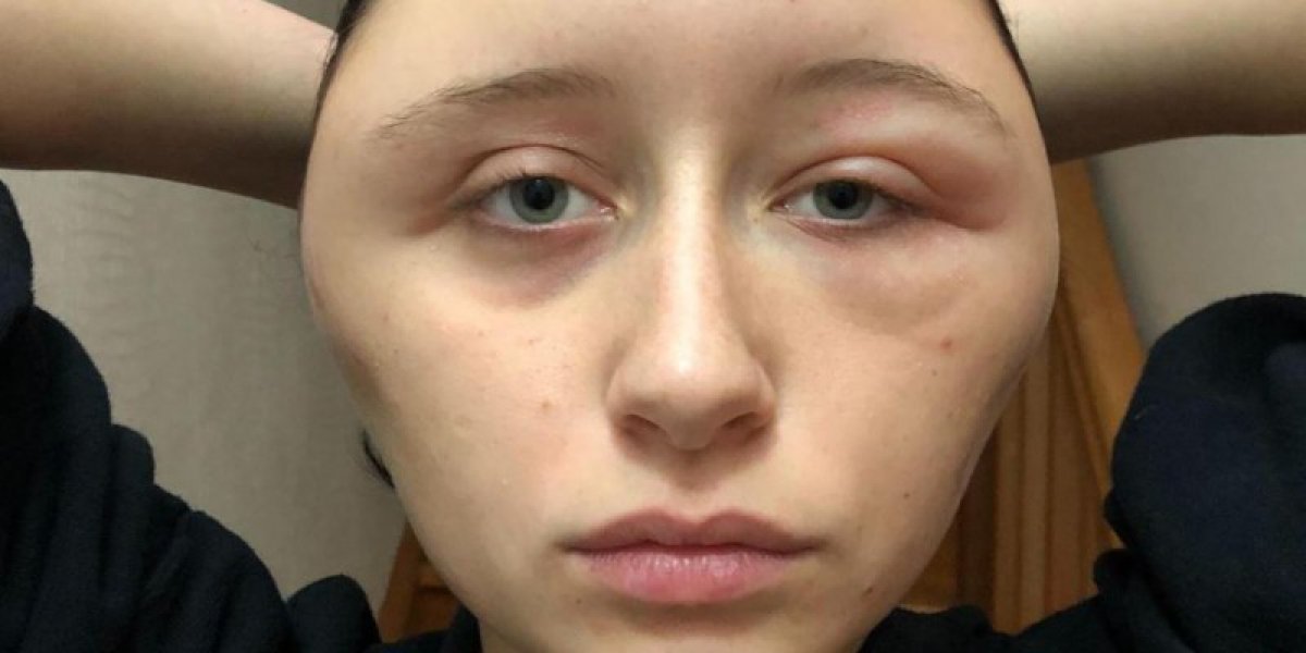 ¡Se pintó el pelo y terminó con una terrible deformación! | Fotogalería ...